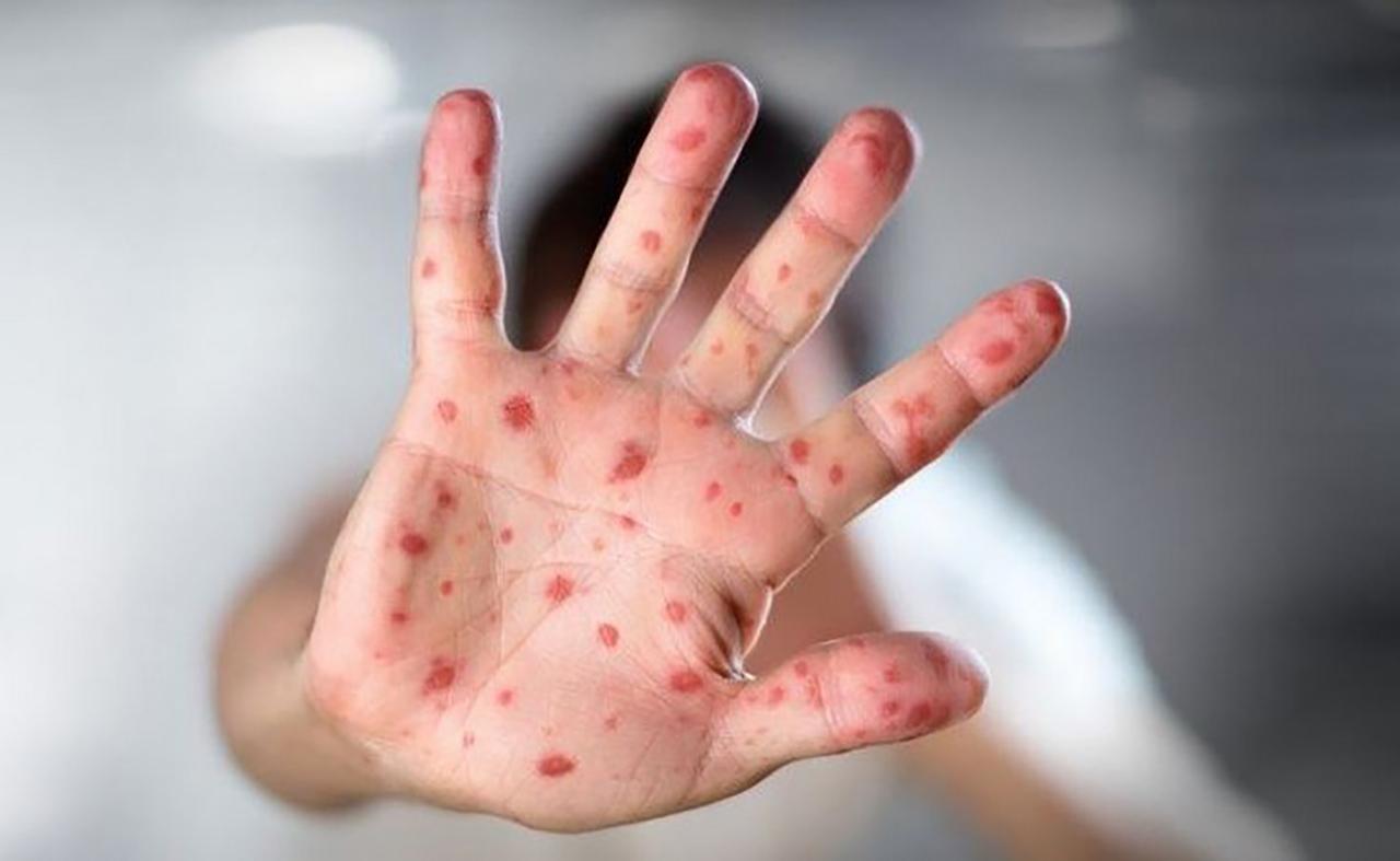 Važne preporuke i informacije u vezi sa širenjem infekcije morbila ...